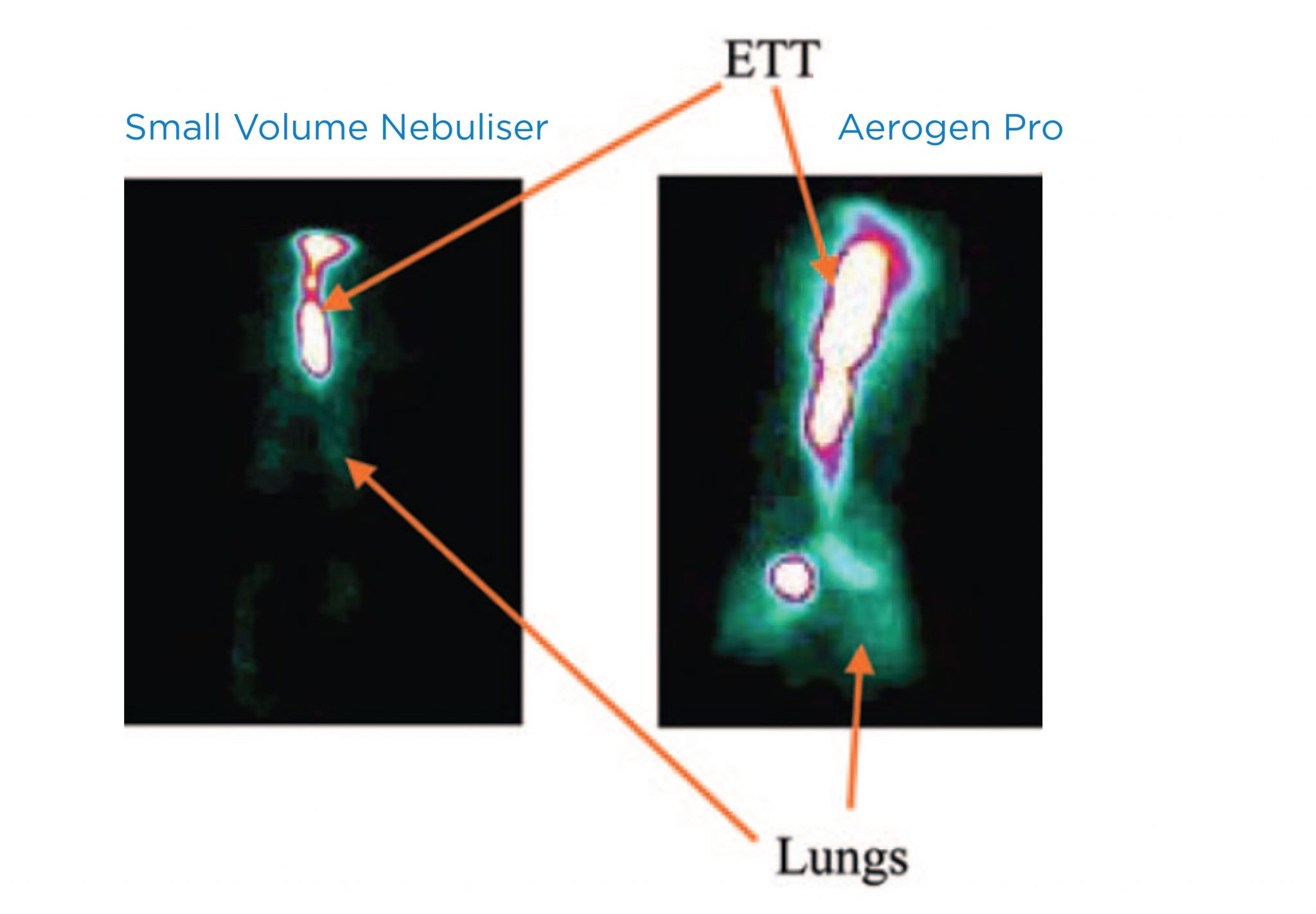 Aerogen High Efficiency Aerosol Drug Delivery During Ventilation