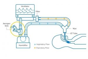 A Lung Recruitment Strategy for Patients with Respiratory Failure ...